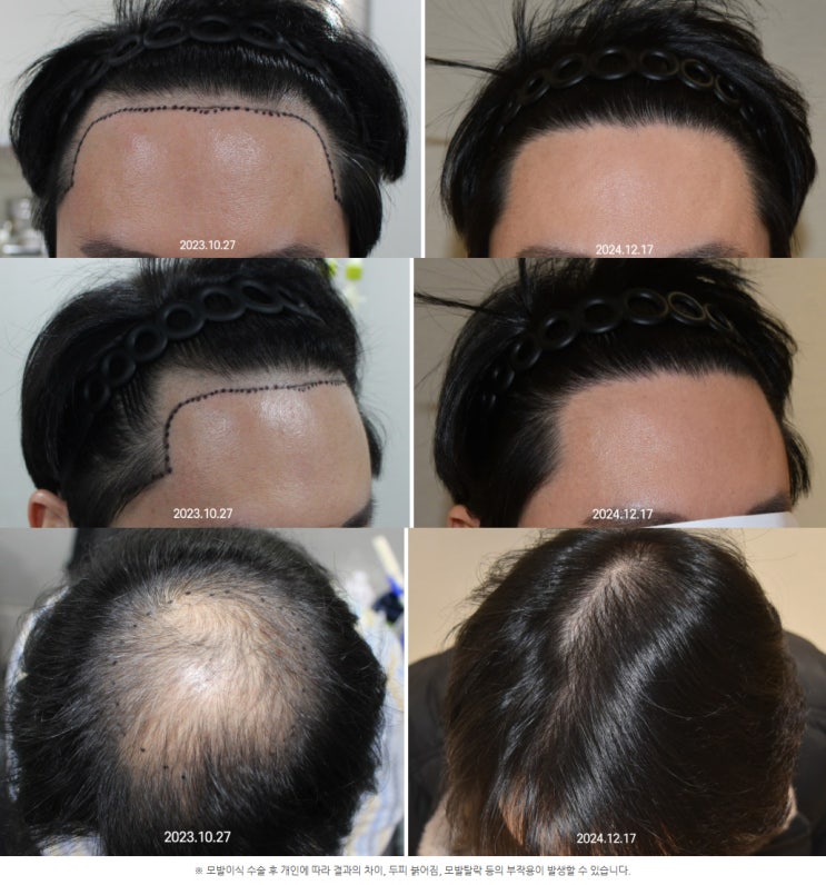 정수리 M자 비절개 모발이식 5600모 전후 : 네이버 블로그