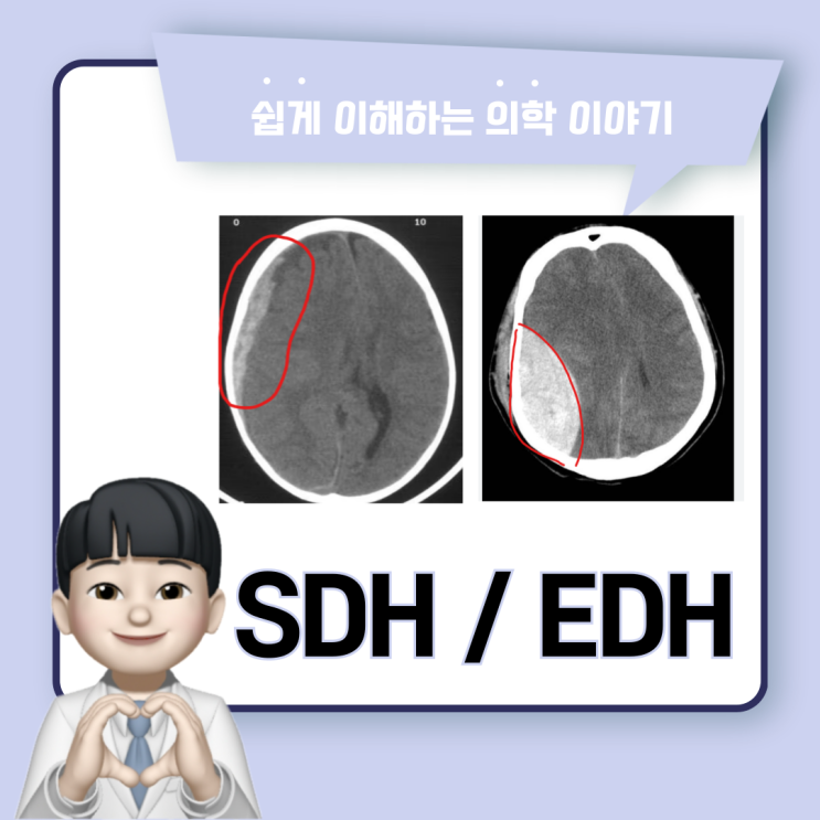 SDH, EDH 의학용어 경막외출혈 및 경막하출혈의 차이점, 증상과 진단 및 치료까지 : 네이버 블로그