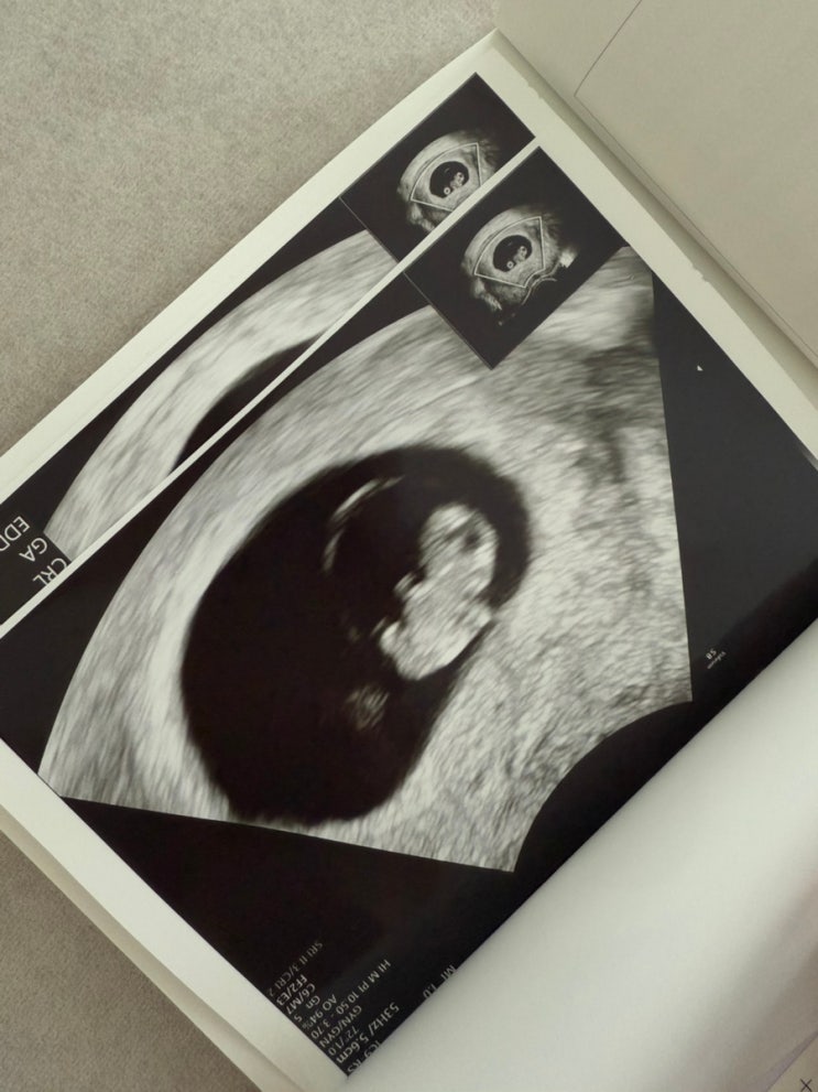 임신스토리.1 유산수술후 자연임신 성공 방법 : 네이버 블로그