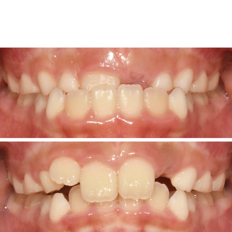 양평 인근 치과 앞니 반대 교합 페이스 마스크 + Bonded RPE 치료 통해 골격 교정 성공한 증례 소개 : 네이버 블로그
