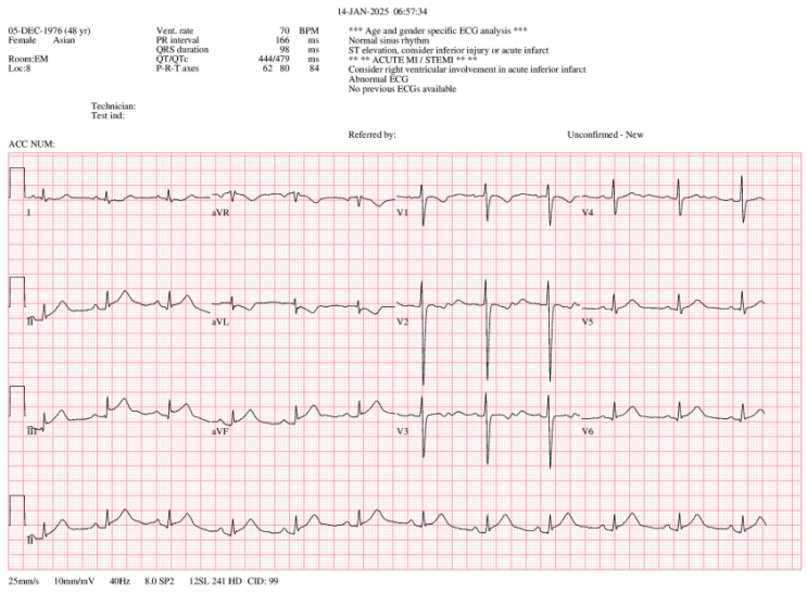 STEMI, inf. wall : 네이버 블로그