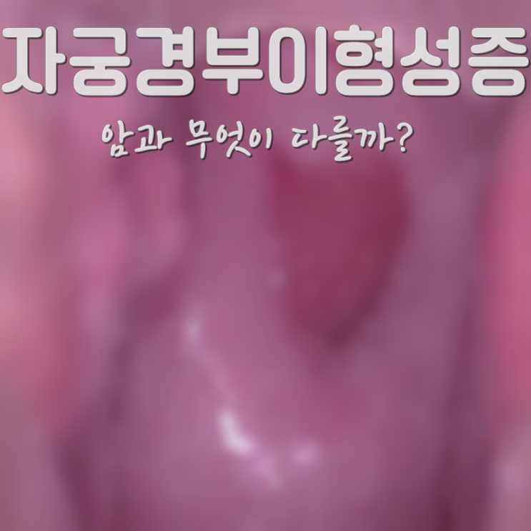 자궁경부이형성증 암과 무엇이 다를까? : 네이버 블로그