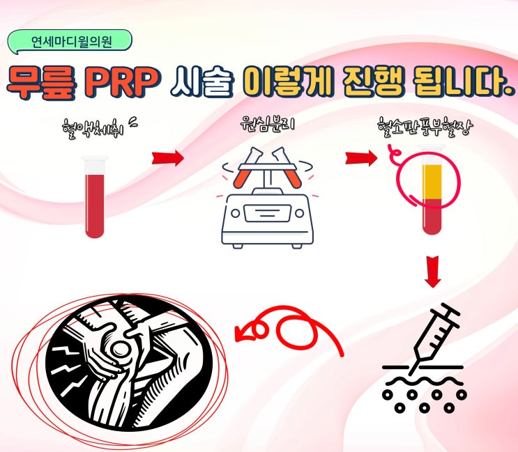 무릎 관절염 치료의 새로운 전환점, 검단 정형외과 PRP 주사치료 : 네이버 블로그