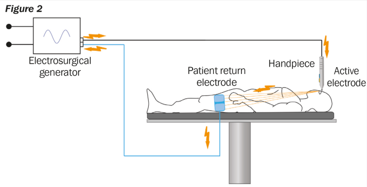 Monopolar Bovie vs bipolar 전기수술 완벽 가이드 - 원리 사용법, 파워 셋팅까지 : 네이버 블로그