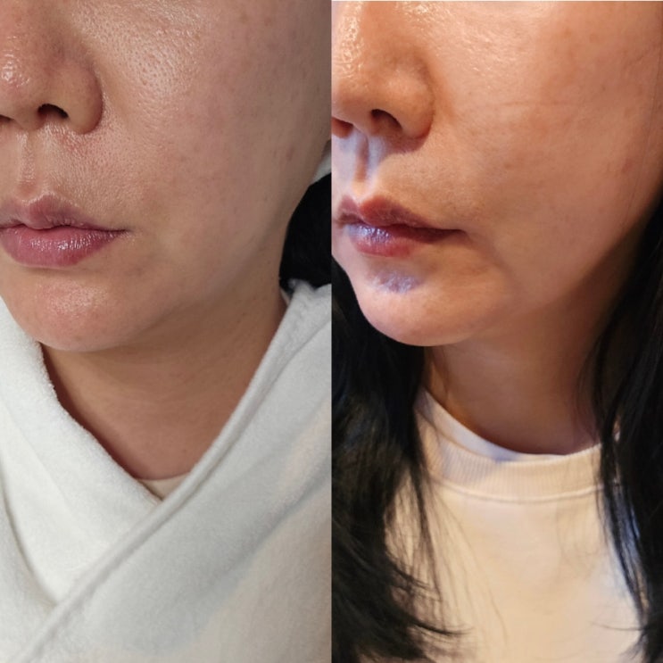 구디피부관리 :: 이중턱 턱라인 리프팅 살롱드세이렌 '바이온다(VIONDA) 리프팅' 3회차 후기 : 네이버 블로그