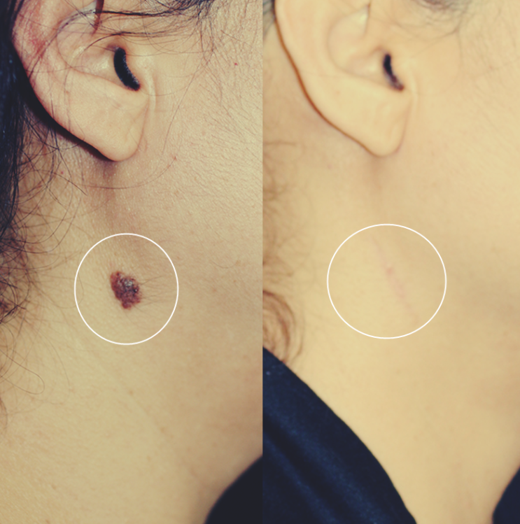 튀어나온 돌출점(= 사마귀점 제거) 피부과 X 성형외과 ㄱㄱ : 네이버 블로그