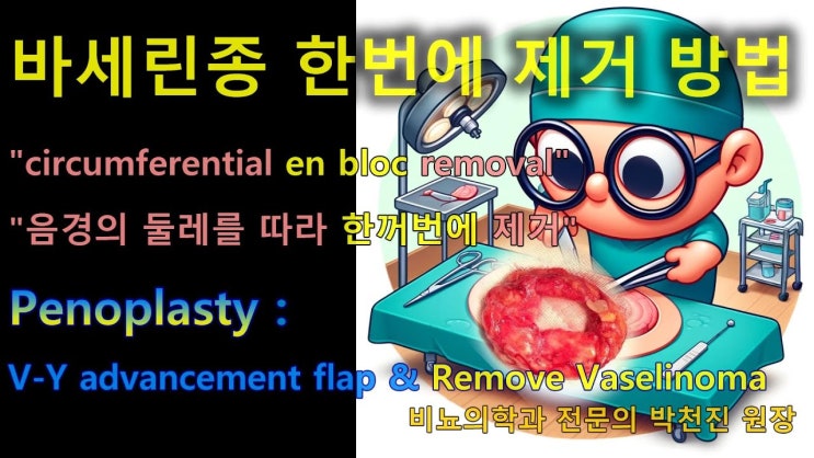 음경의 둘레를 따라 바세린 제거를 한번에+음경 피부당김까지 해결 하는 수술영상 Penoplasty :V-Y advancement ...