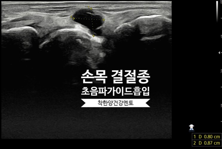 손가락 또는 손목에 혹이 생겼다면? 결절종(Ganglion Cyst) 진단과 치료 방법 : 네이버 블로그