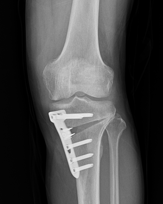 Knee-HTO(high tibial osteotomy) 근위경골절골술/오다리교정술/휜다리 교정술 : 네이버 블로그