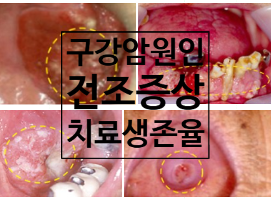 구강암 초기 전조증상 원인 치료 생존율 총정리 네이버 블로그
