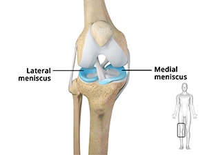반월판절제술 menisectomy란? 수술부터 회복까지 : 네이버 블로그