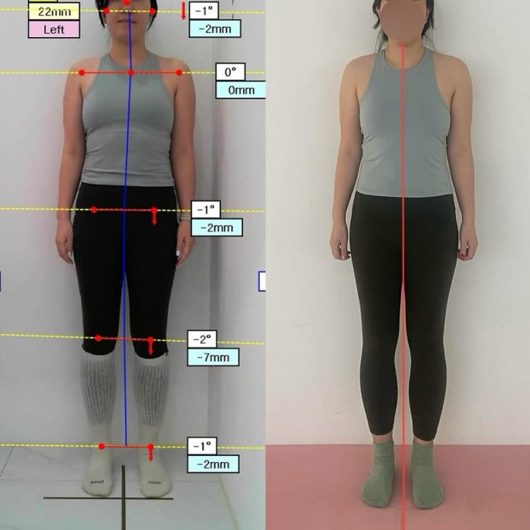 [부산SNPE][SNPE부산][부산대 체형교정] 지은쌤 목,어깨,허리통증 + 전방경사, 골반비대칭 비포애프터 : 네이버 블로그