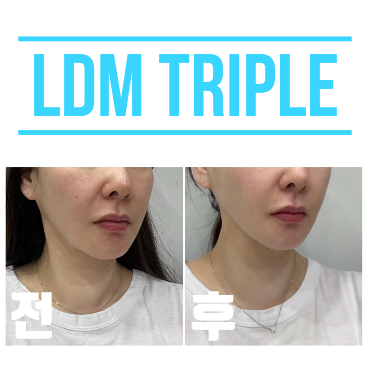 서울 가산역 피부과 LDM 트리플 엘디엠 triple 관리 효과 차이비교 : 네이버 블로그