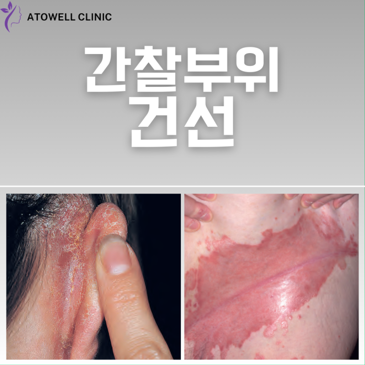 간찰부위 건선(Psoriasis Inversus) 완벽 가이드: 원인·증상·치료·관리까지 ㅣ경주건선치료 ㅣ피부과추천 : 네이버 블로그