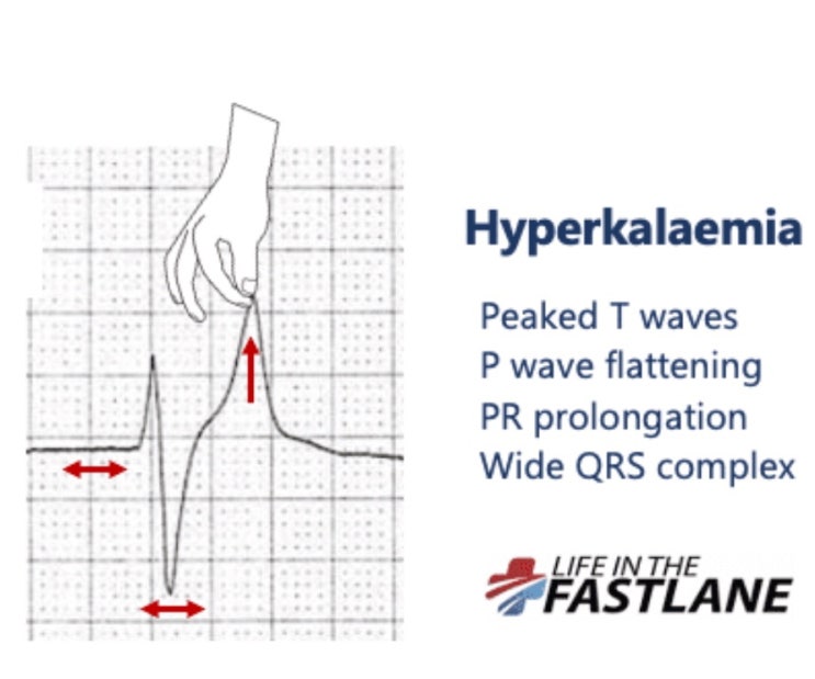 EKG 해석 - Potassium 수치 (Hypokalemia)와 ECG 의 상관관계 : 네이버 블로그