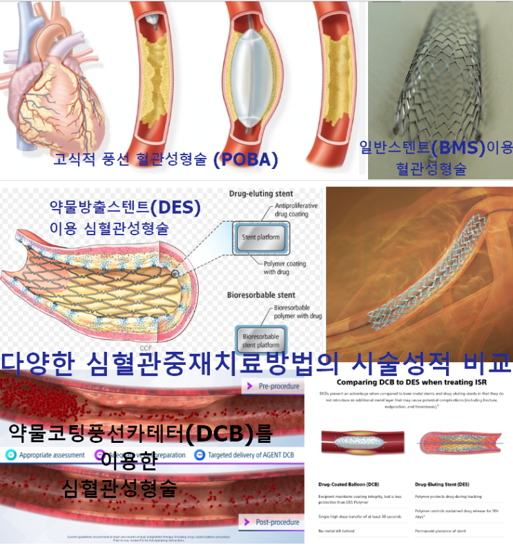 2.75mm 이하 심혈관 중재치료 방법에 따른 임상성적비교(POBA vs BMS vs DES vs DCB ) : 네이버 블로그