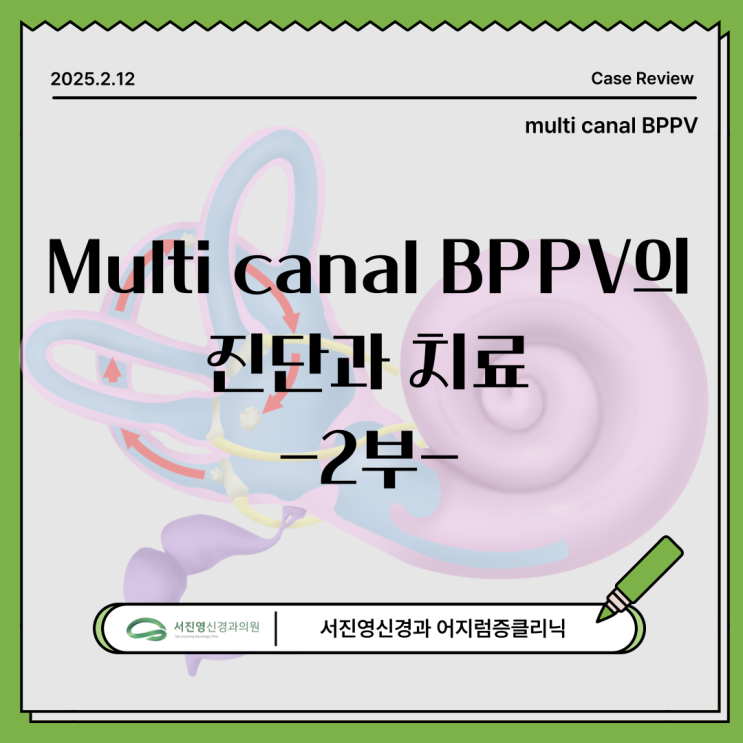 [BPPV][학술] Multi canal BPPV의 진단과 치료 : 2부, PSCC canalolithiasis ...