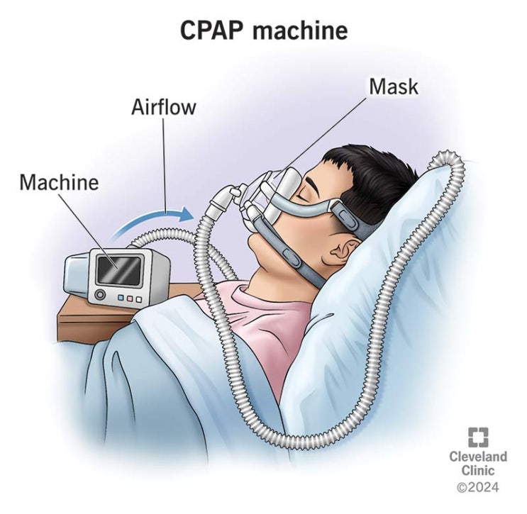CPAP 기계부터 수가 산정까지, 한눈에 보기 : 네이버 블로그