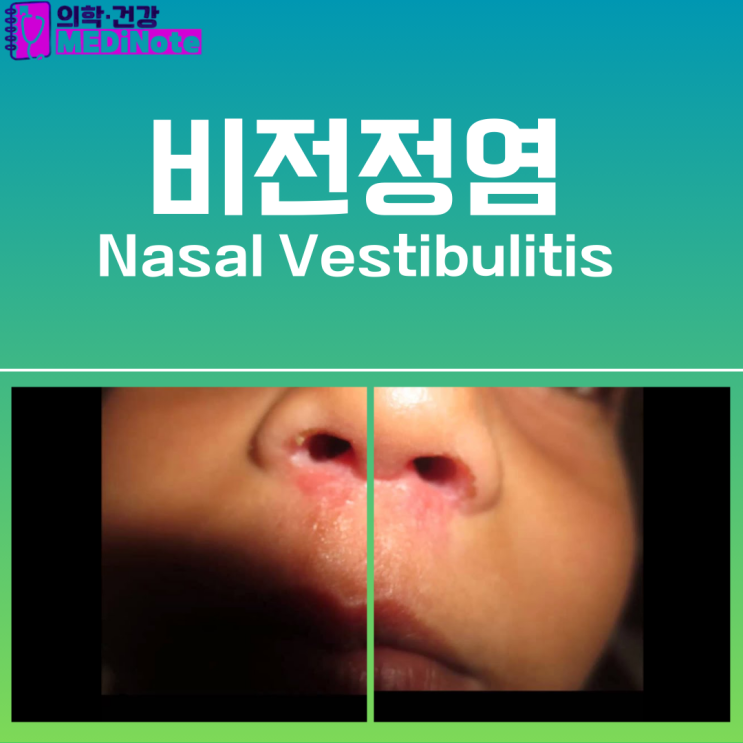 비전정염(Nasal Vestibulitis) & 황색포도상구균(S. aureus) 감염 관리: 원인·예방·치료 가이드 ㅣ경주코 ...