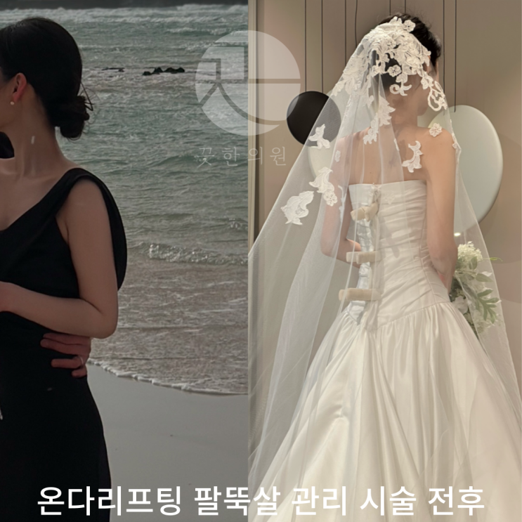 구로 팔지방흡입? 일단 하지마세요. 부작용 없이 가능한 00 : 네이버 블로그