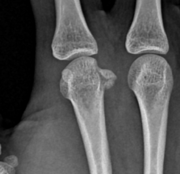 F/20 2nd MC UCL avulsion fracture. : 네이버 블로그