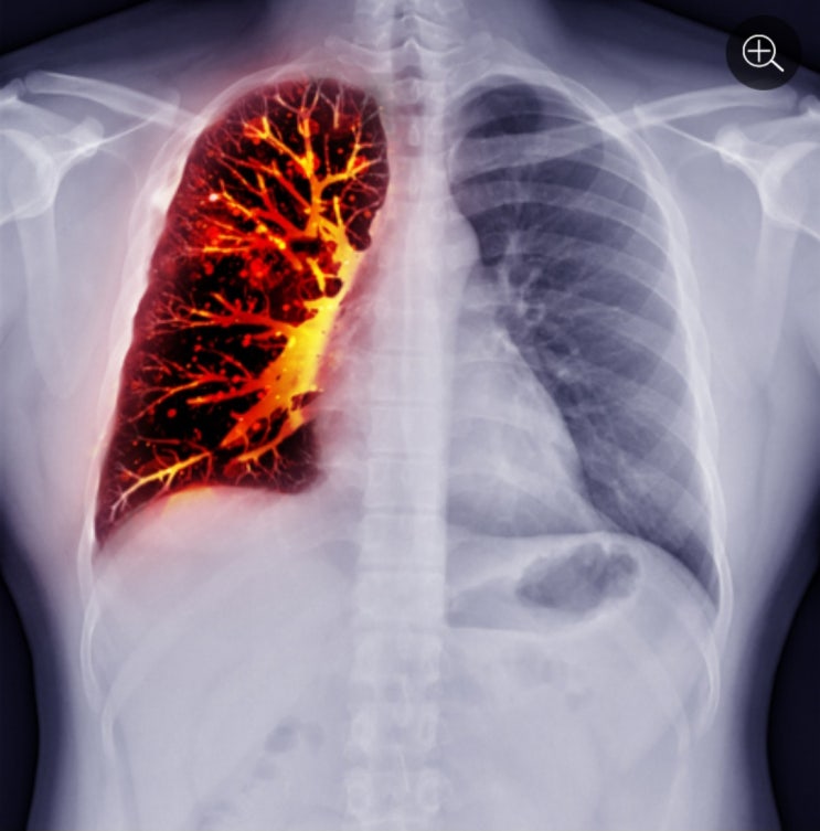 시한부 생존/폐섬유증(Idiopathic Pulmonary Fibrosis, IPF). : 네이버 블로그