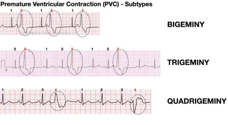 PVC 의학용어 (심실조기수축, Ectopic, Bigeminy, Trigeminy ) 개념 공부하기 : 네이버 블로그