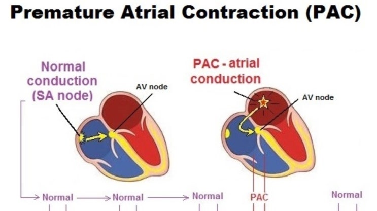 심방조기수축 (APC, PAC 의학용어) 공부하기 Premature Atrial Contraction : 네이버 블로그