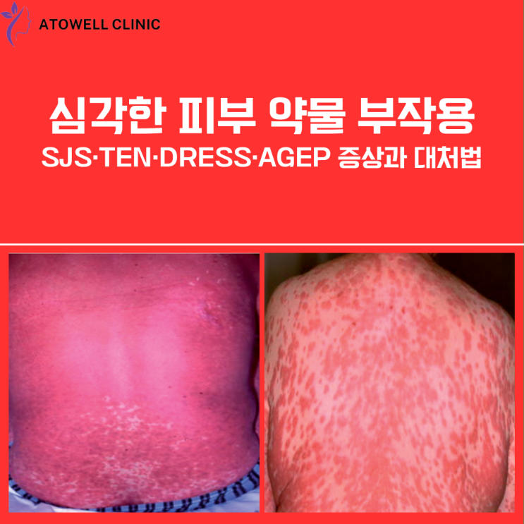 심각한 피부 약물 부작용(SCAR): SJS·TEN·DRESS·AGEP 증상과 대처법 총정리 : 네이버 블로그