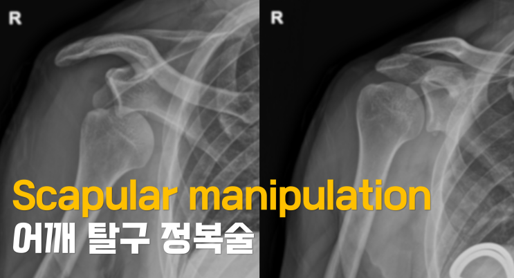 Anterior dislocation of the shoulder and closed reduction (ft. scapular ...