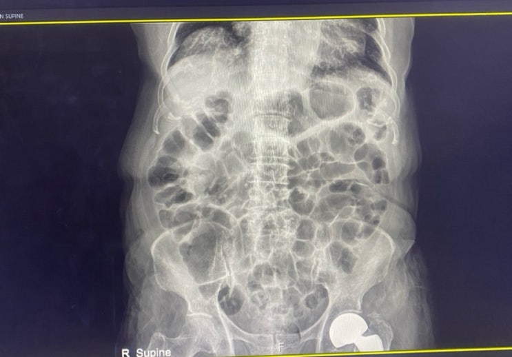 abdomen x-ray 간단 판독법 : ileus 장폐색 치료 : 네이버 블로그