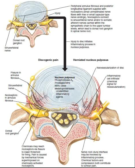 허리를 삐었어요 - 요통 ; 관절통, T-L junction syndrome, SI joint pain(천장관절); 물리치료 ...