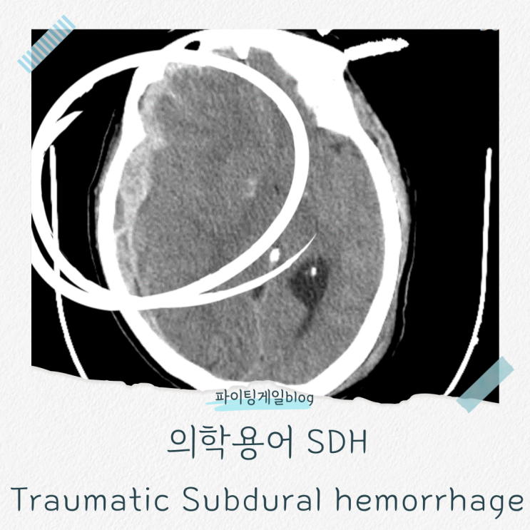 의학용어 SDH, Traumatic Subdural hemorrhage : 네이버 블로그