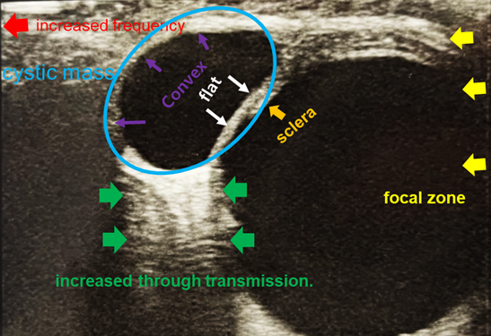 Case Review_37:왼쪽 눈꺼풀 아래 혹이 있는 61세 남성- Conjunctival inclusion cyst(결막 ...