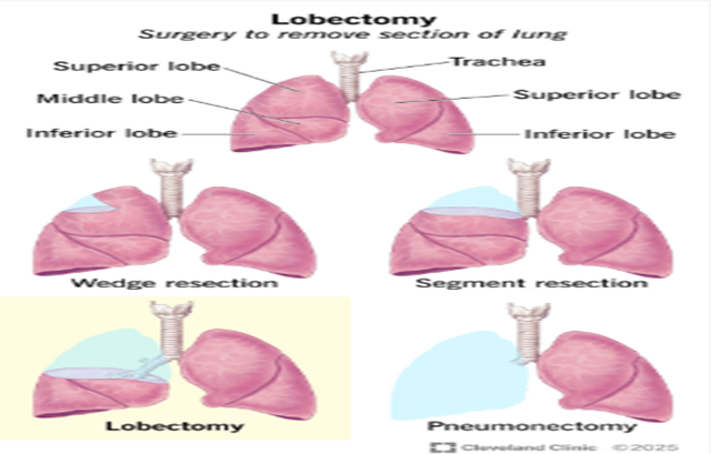 Lobectomy: Chest tube 관리 : 네이버 블로그
