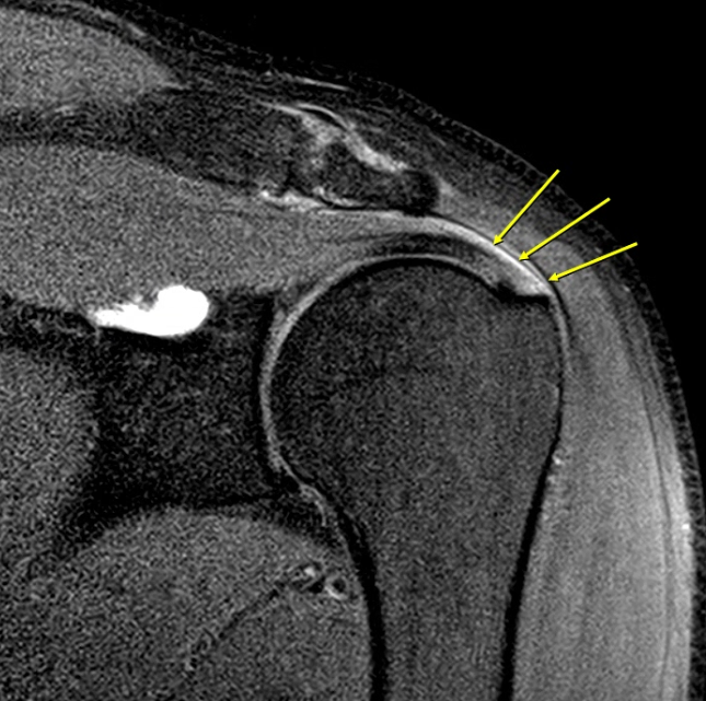 상부관절와순파열 및 낭종, SLAP lesion(슬랩)과 paralabral cyst에 대한 치료 예시 및 회복 과정 기간 ...