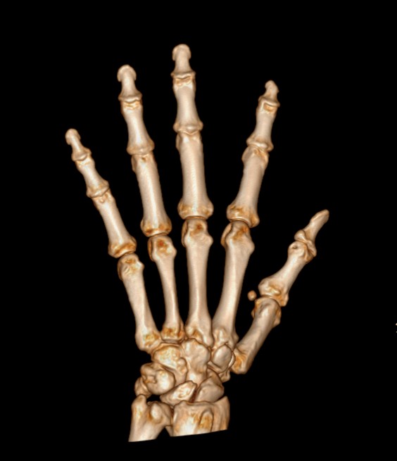 OA in DIP joints and 1st IP joint, 5th PIP joint : 네이버 블로그
