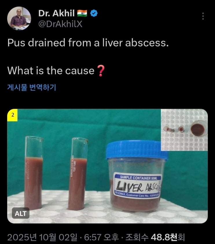 typical anchovy sauce of amoebic liver abscess : 네이버 블로그