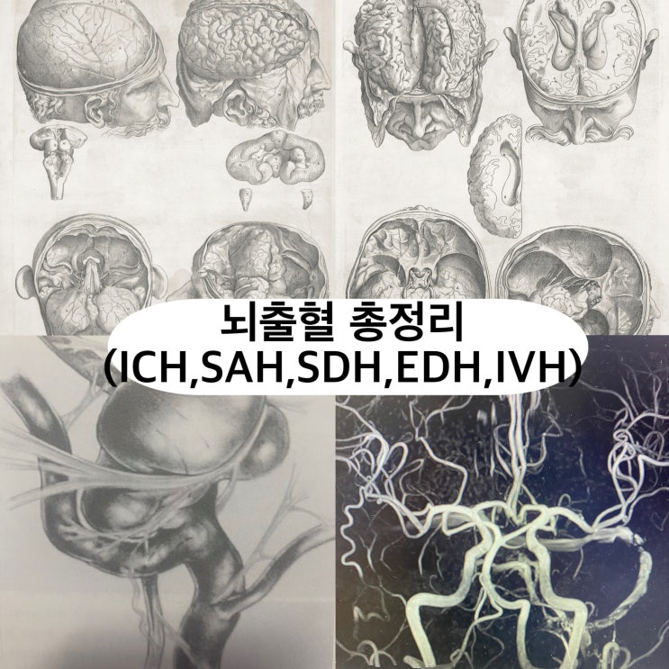 뇌출혈 총정리 – ICH, SAH, SDH, EDH, IVH 비교 한눈에 보기 : 네이버 블로그
