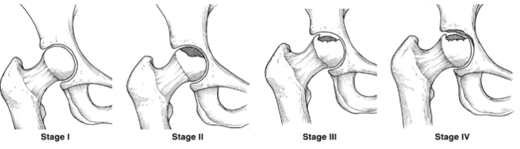 FICAT stage... + Arlet, ARCO : 네이버 블로그