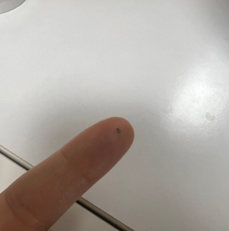 깨순이의 주근깨 터는 날 / 압구정 피부과 루비레이저 내돈내산 주근깨 시술 후기 / 759방 / 당일~ 1주 : 네이버 블로그