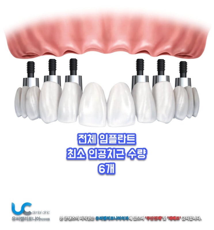 전체 임플란트가격 추천 수량과 보철종류차이 : 네이버 블로그