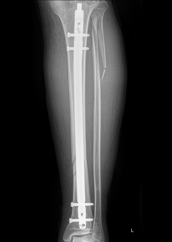 M/47 distal tibia fx . MIPO?IM nail 여러분의 선택은? : 네이버 블로그