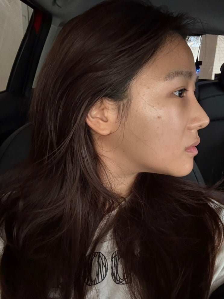 잠실 인모드 FX 포마 1달차 효과 후기 : 네이버 블로그