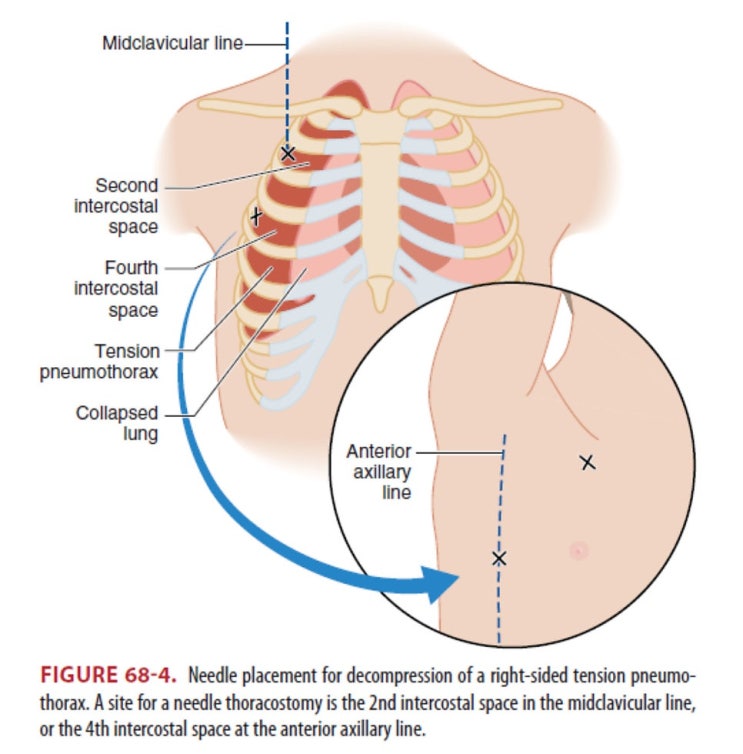 Tension pneumothorax, Needle Decompression : 네이버 블로그