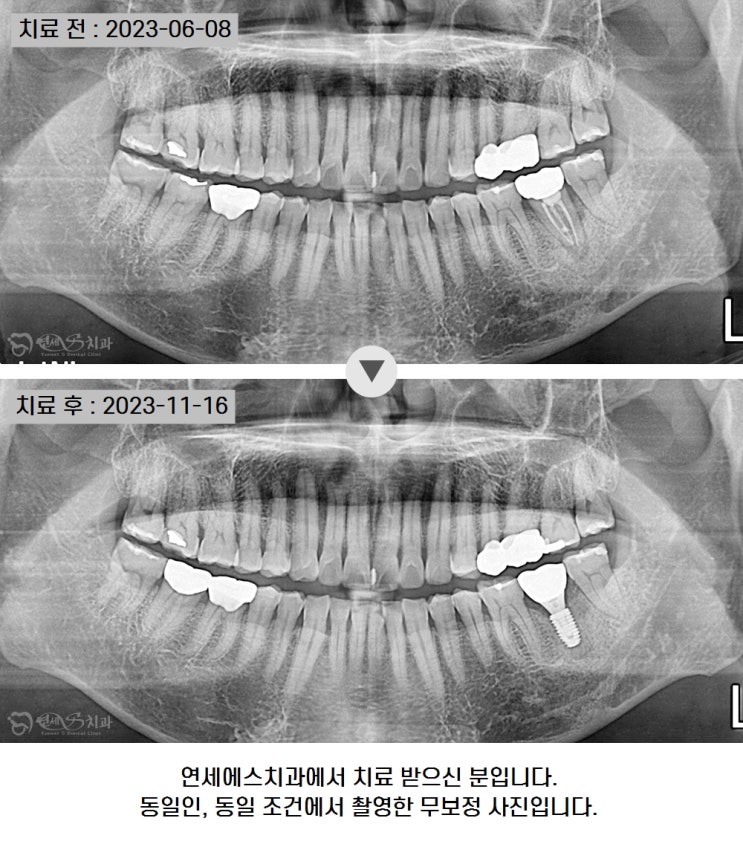 씹을 때 턱아픔 어금니 통증 아픔, 욱신, 잇몸 뿌리 염증 부음_임플란트 후기 : 네이버 블로그