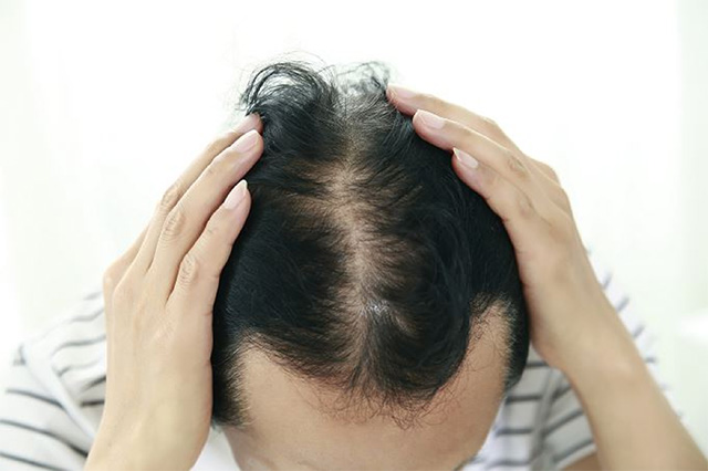 150만원 가르마두피문신 VS 300만원 모발이식 (비교) : 네이버 블로그