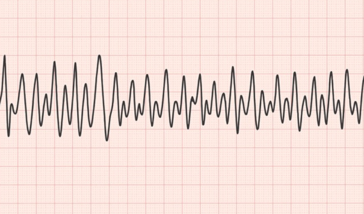arrest 의학용어, vtach, vfib, shockable nonshockable rhythm, defibrillation ...