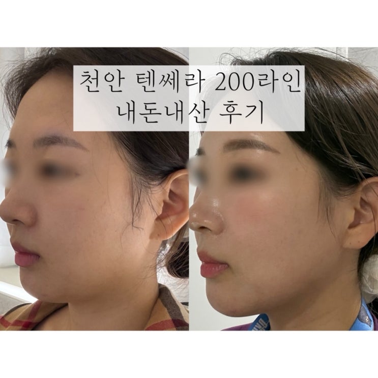 천안 불당동 피부과 텐쎄라 200라인 내돈내산 후기 : 네이버 블로그