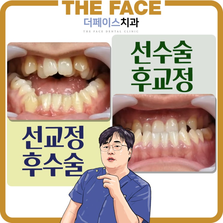 교정부터 VS 수술부터, 나에게 맞는 양악수술방법 찾는 방법! : 네이버 블로그